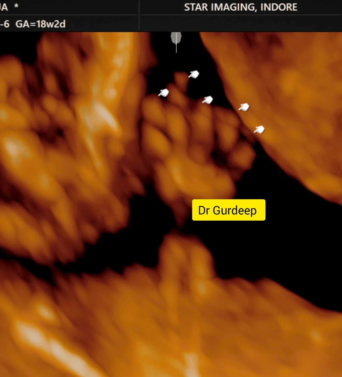 Fetal Digits Finger counting - Star Imaging & Path Lab Indore ...